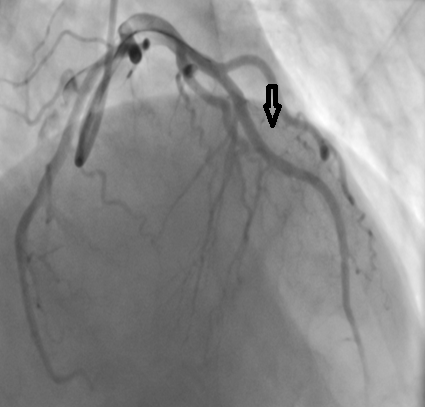 A Clinical Case Of Stent Implantation Into The Area Of The Myocardial ...